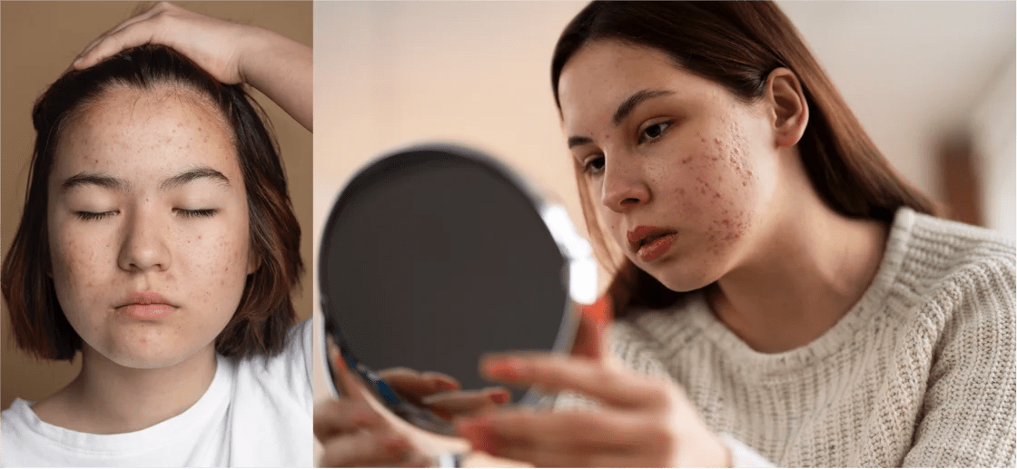 Acné Hormonal y Sus Causas - oby.mx